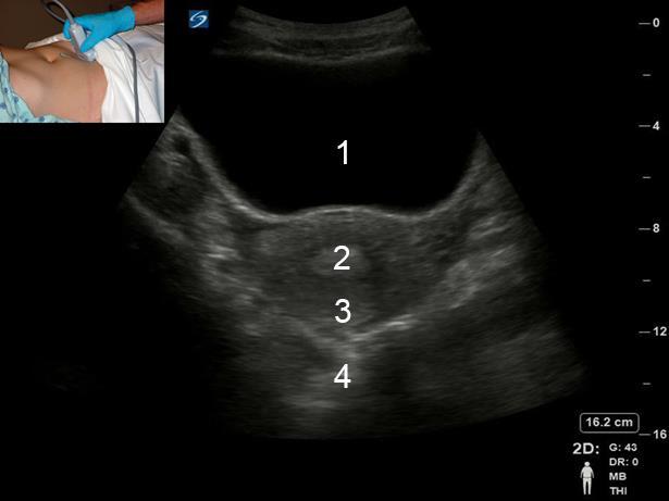 Pelvic Transverse Uterus Sweep Image | Sonosite Institute for Point-of-Care Ultrasound